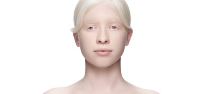 Desafíos Visuales de las Personas Albinas | Óptica Baca en Ronda